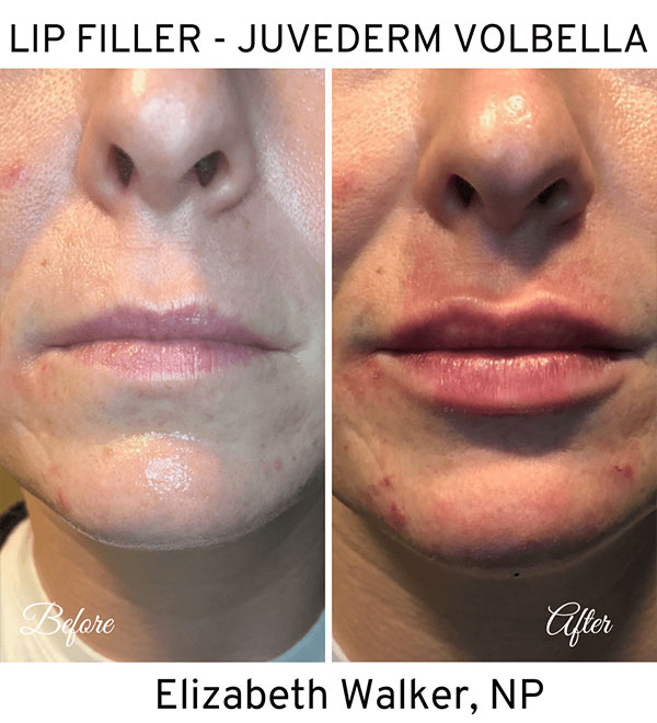 Dermal Fillers - Metropolitan Dermatology