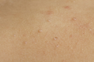 Molluscum Contagiosum Treatment New Jersey | Book Online | Metropolitan ...